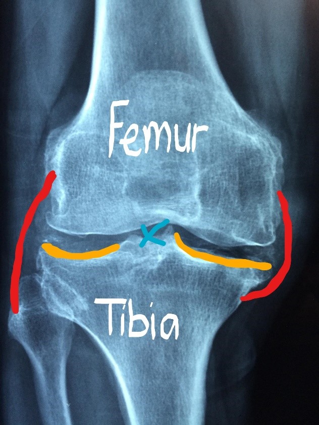 What's Going on With My Knee? :: Arvada Sport & Spine